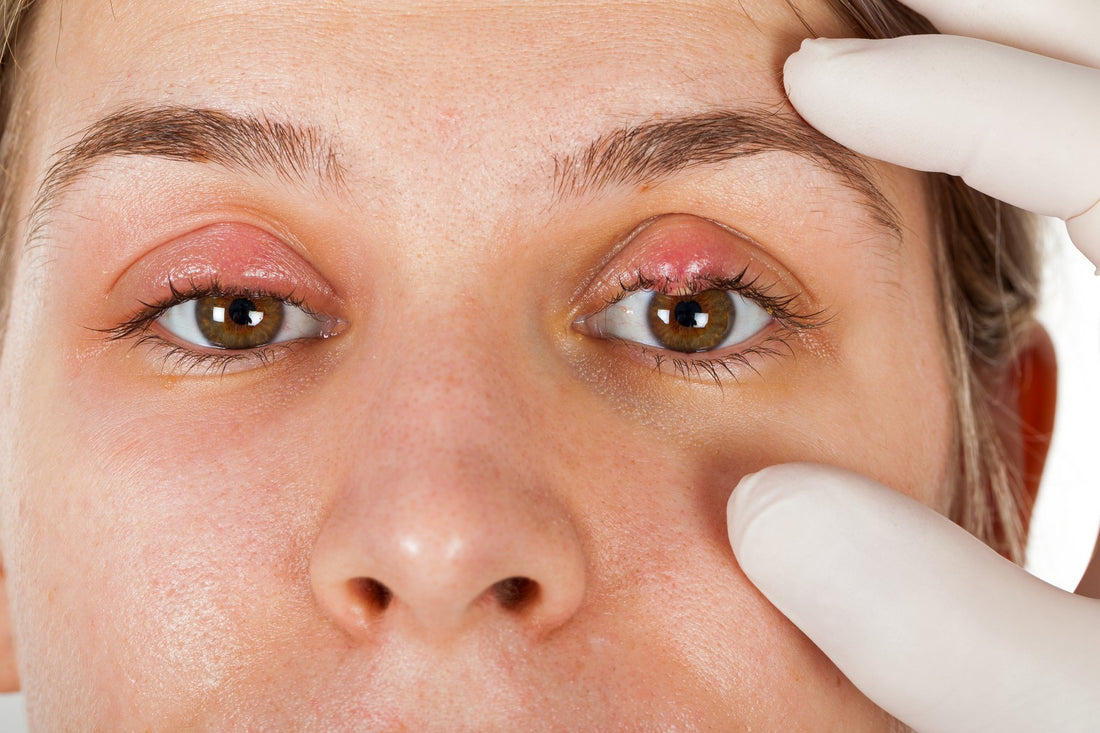 Stye - what is it? What causes it? And how to treat it | OCULA